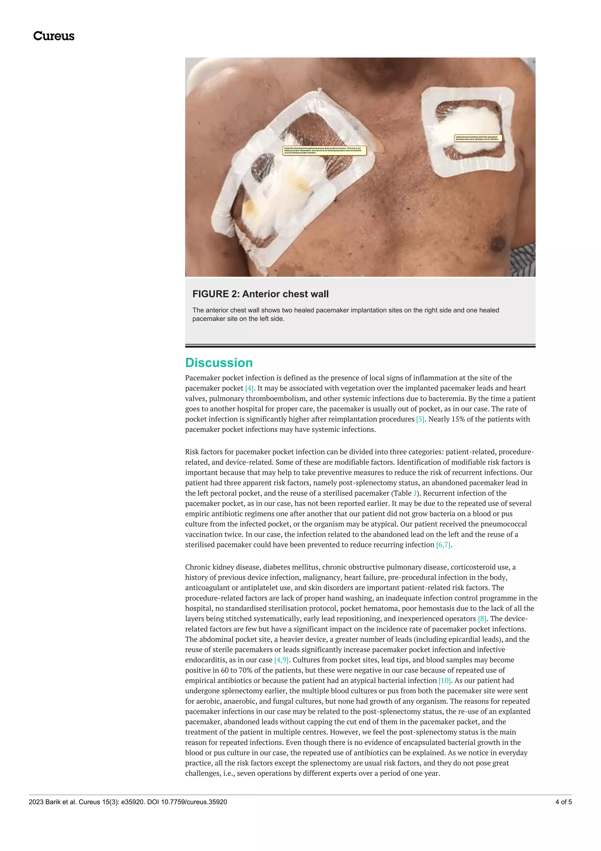 Pacemaker Pocket Infection After Splenectomy | PDF