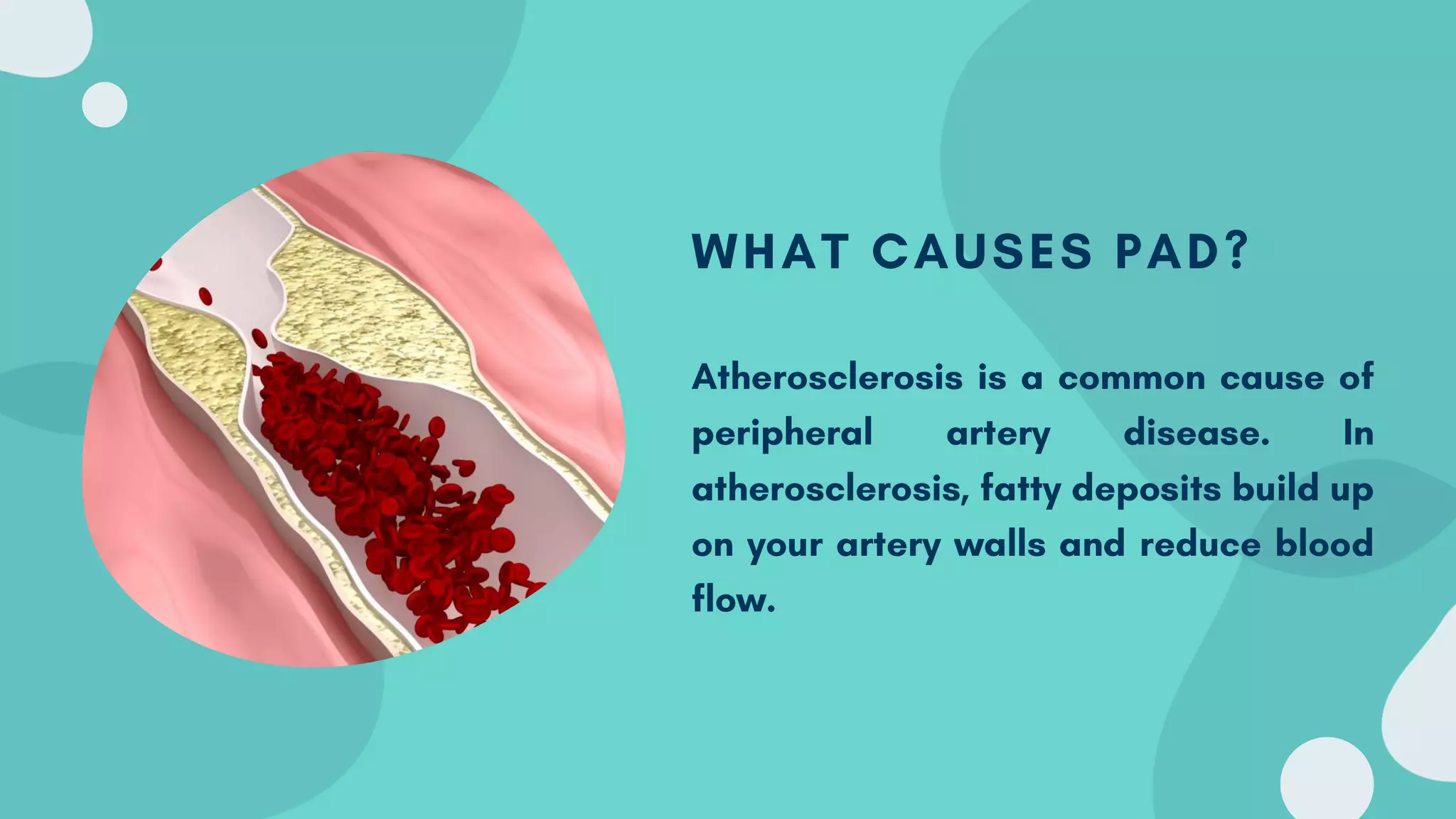 Curing Peripheral Artery Disease With Stem Cell Therapy - Dr. David ...