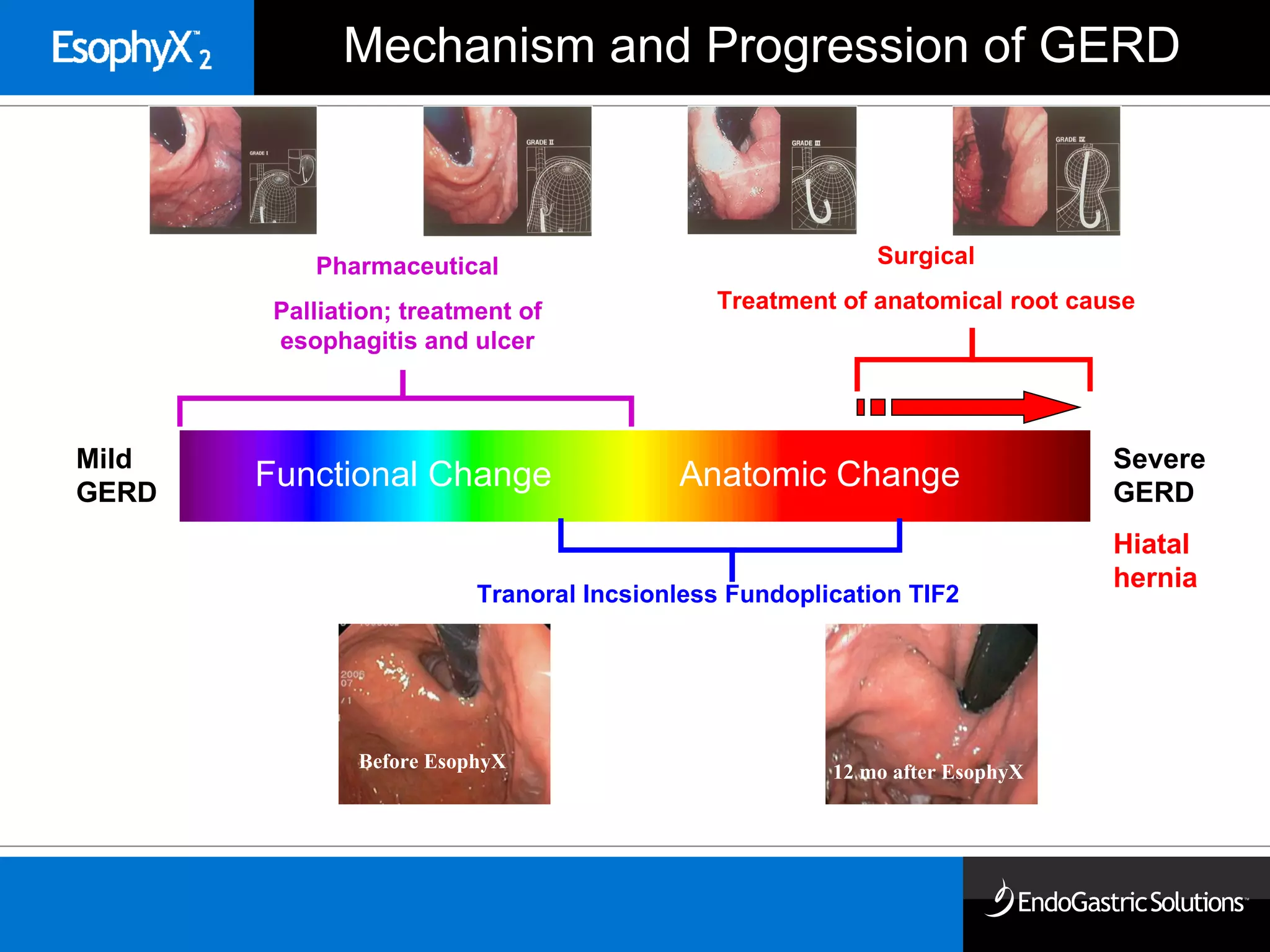 Overview of Endoscopic Gastric Fundoplication | PPT