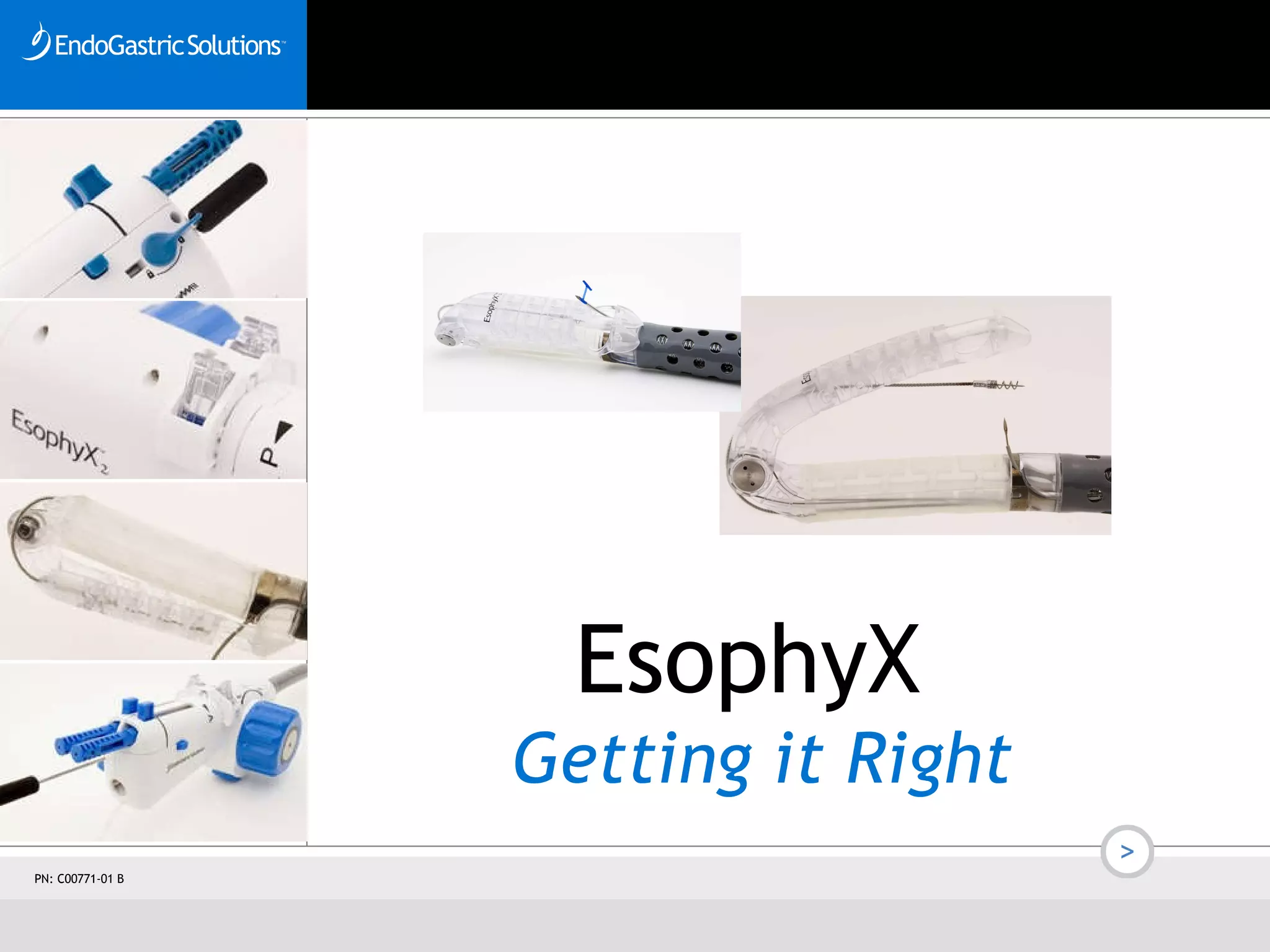 Overview of Endoscopic Gastric Fundoplication | PPT