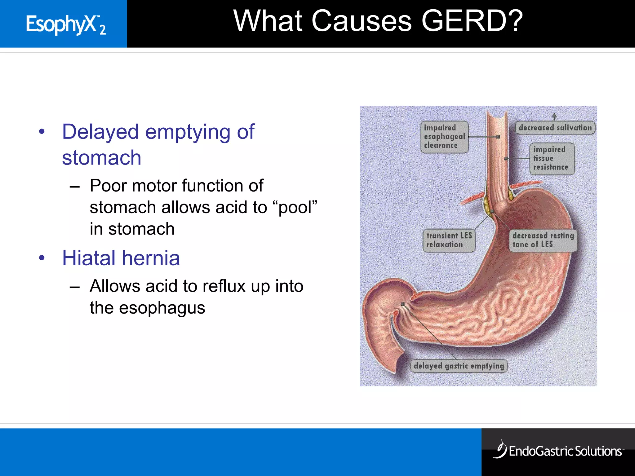 Overview of Endoscopic Gastric Fundoplication | PPT