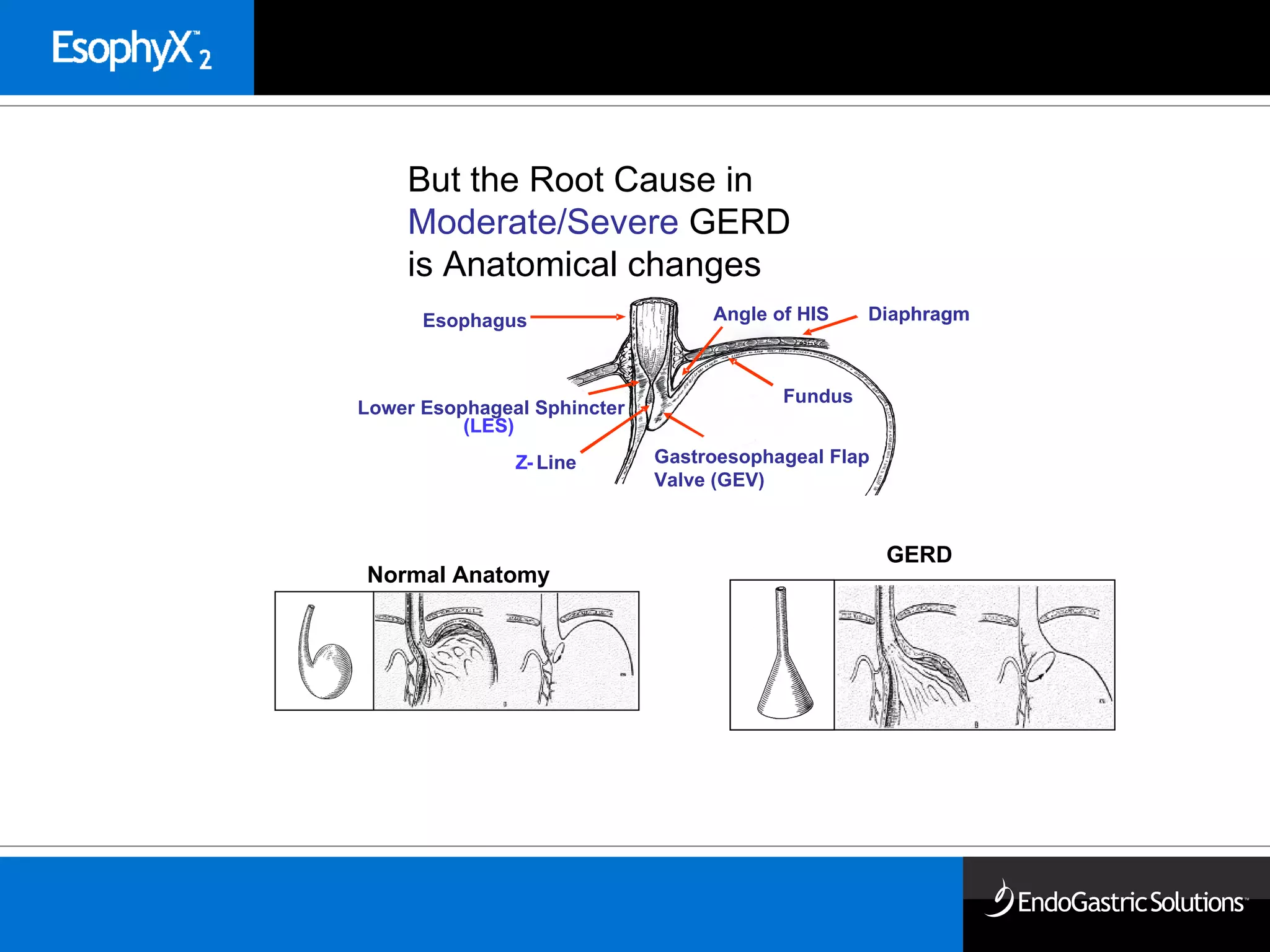 Overview of Endoscopic Gastric Fundoplication | PPT