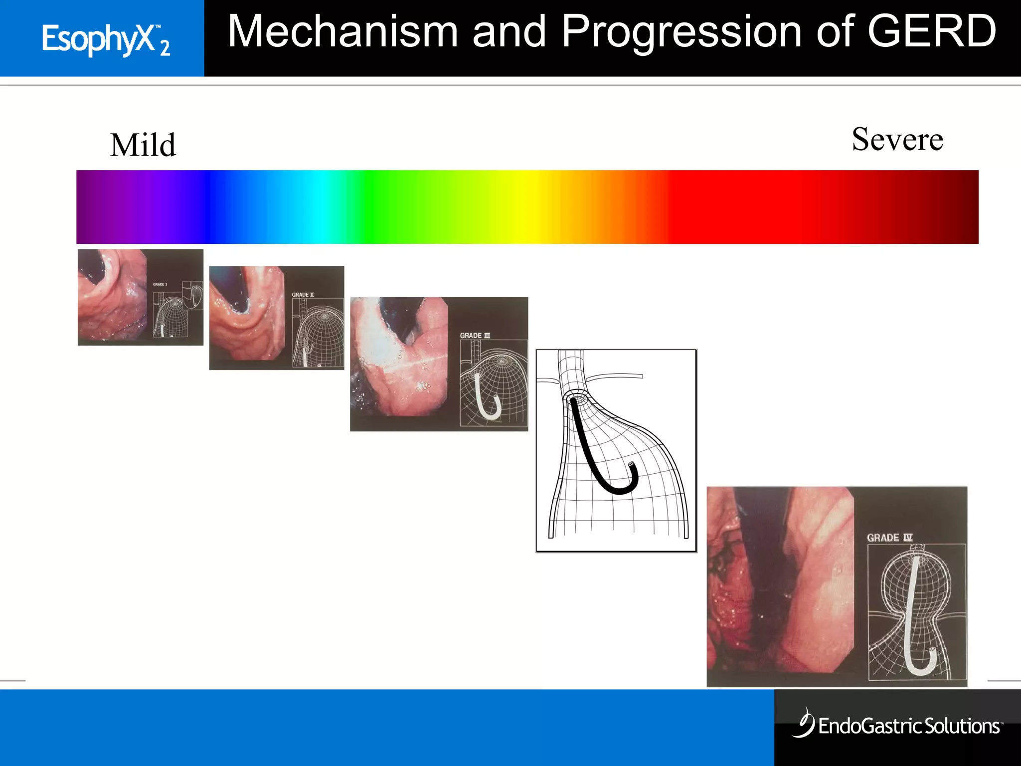 Overview of Endoscopic Gastric Fundoplication | PPT