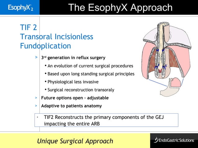 Overview of Endoscopic Gastric Fundoplication | PPT | Digestive ...