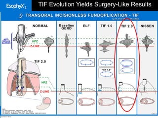 Overview of Endoscopic Gastric Fundoplication | PPT