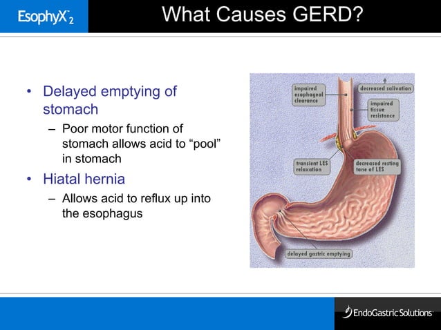 Overview of Endoscopic Gastric Fundoplication | PPT | Digestive ...