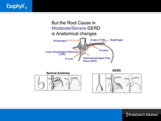Overview of Endoscopic Gastric Fundoplication | PPT
