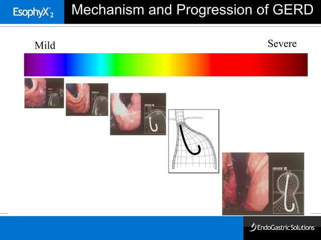Overview of Endoscopic Gastric Fundoplication | PPT | Digestive ...