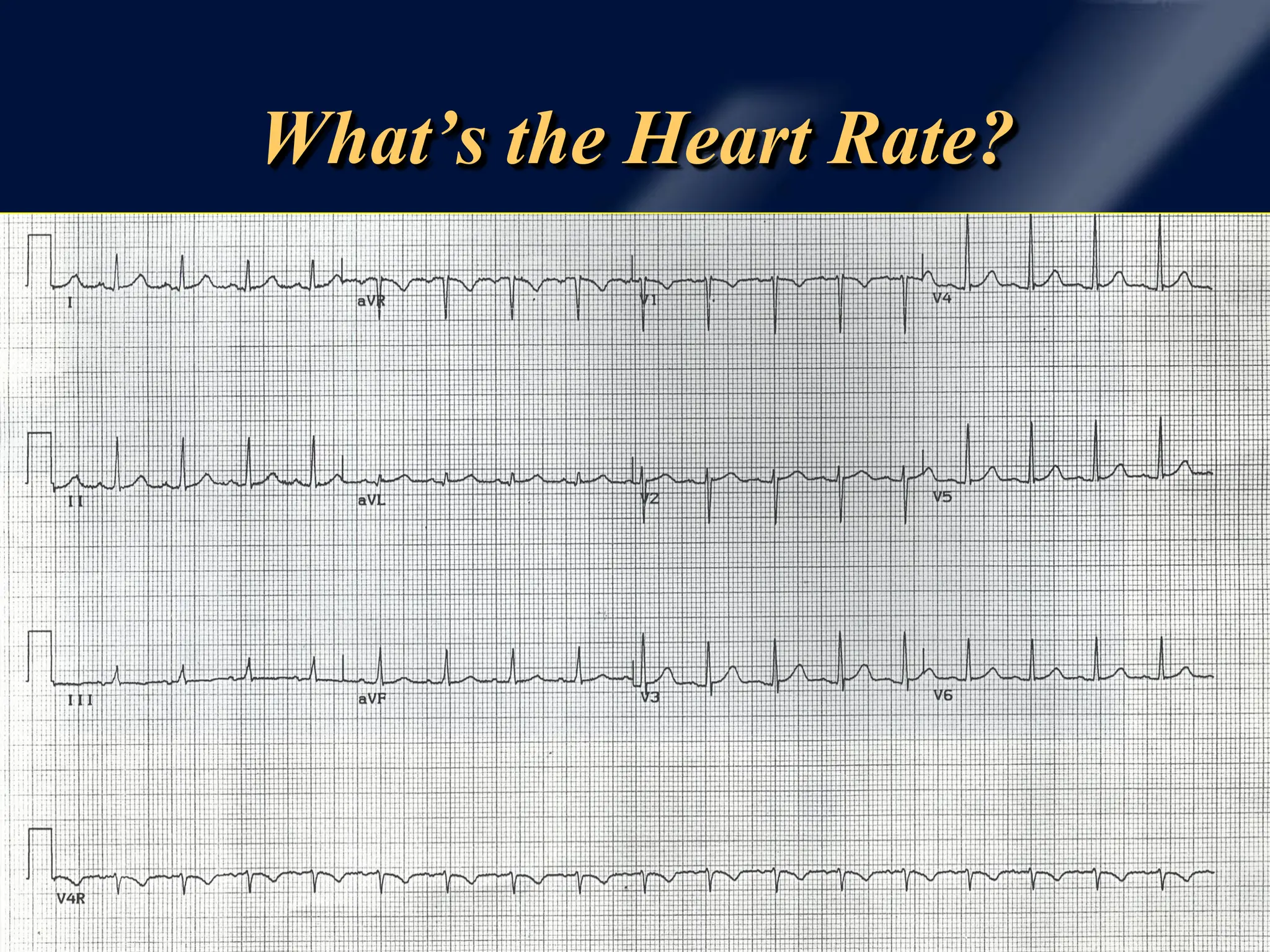Pediatric EGC interpretation... Overview of pediatric ECG | PDF