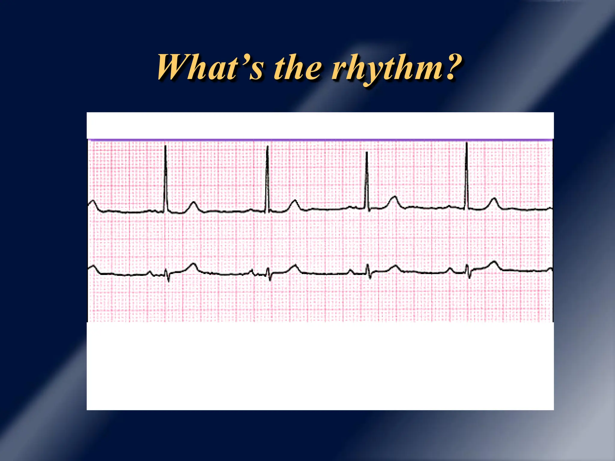 Pediatric EGC interpretation... Overview of pediatric ECG | PDF
