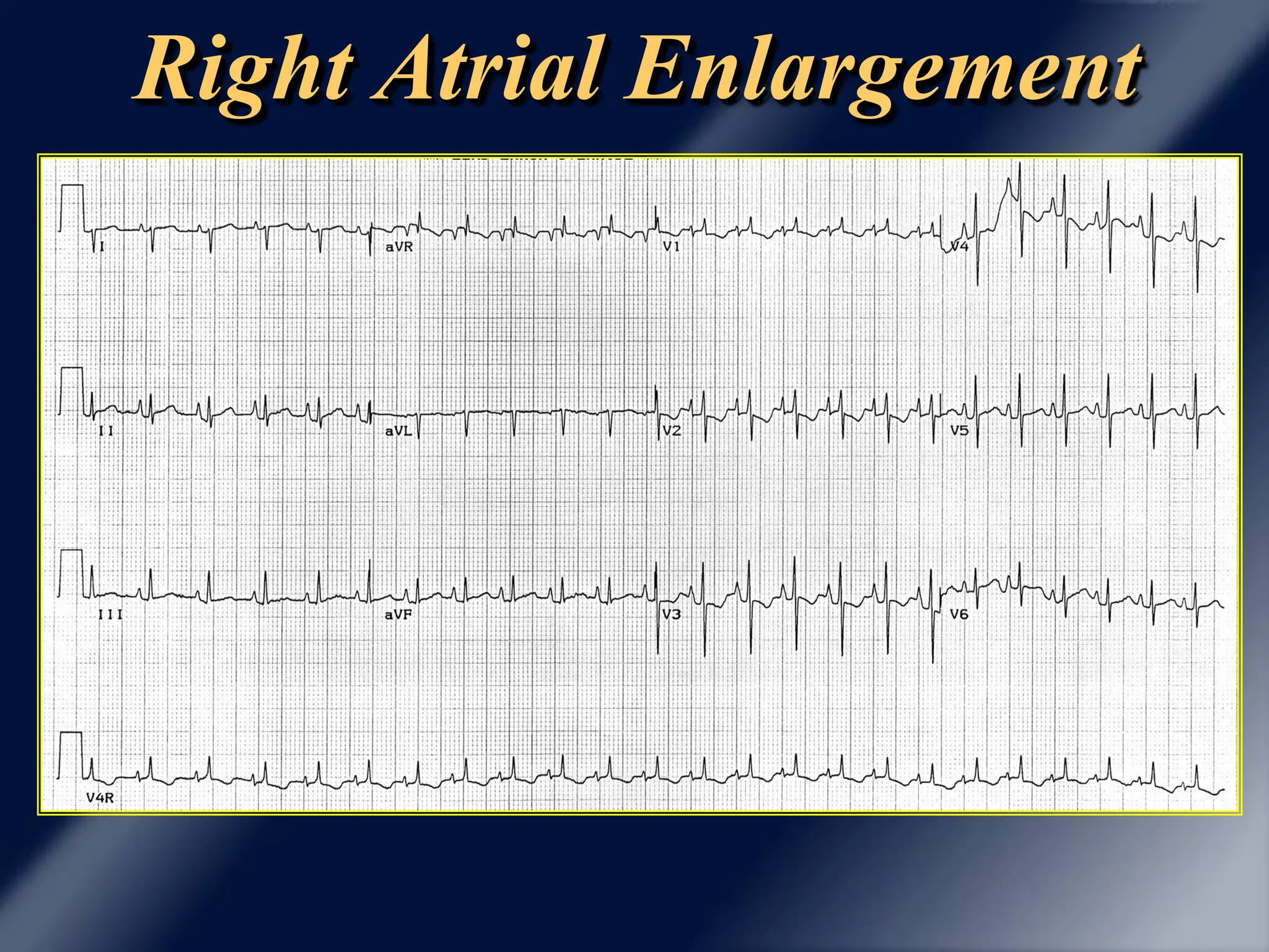 Pediatric EGC interpretation... Overview of pediatric ECG | PDF
