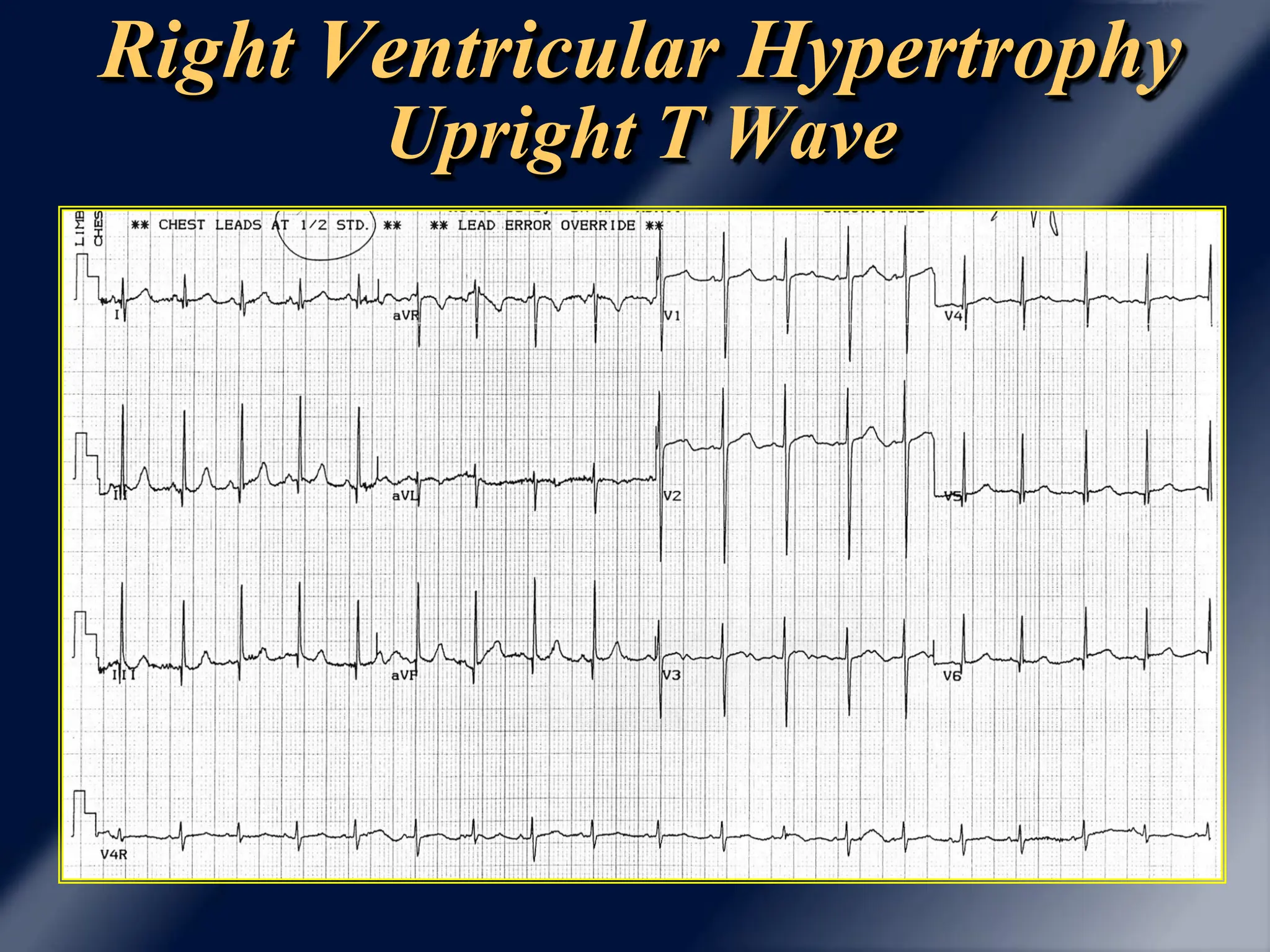 Pediatric EGC interpretation... Overview of pediatric ECG | PDF