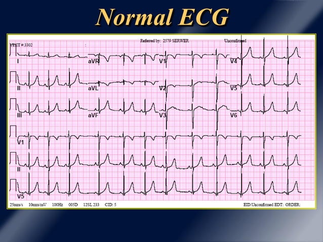 Pediatric EGC interpretation... Overview of pediatric ECG | PDF