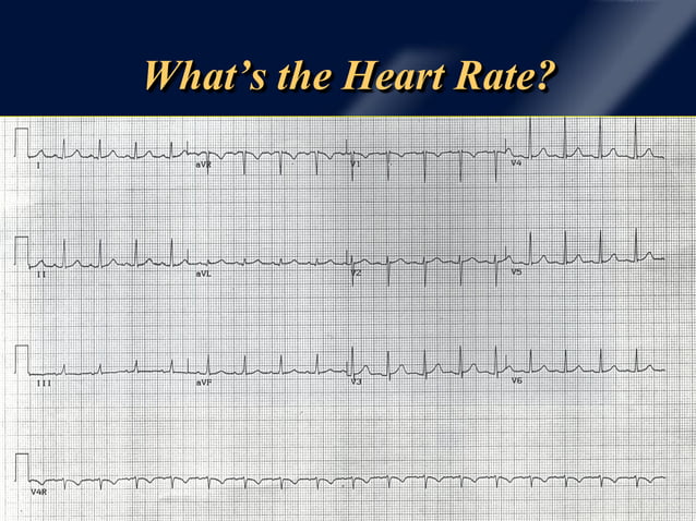 Pediatric EGC interpretation... Overview of pediatric ECG | PDF