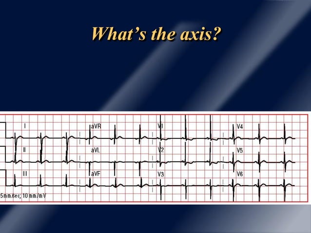 Pediatric EGC interpretation... Overview of pediatric ECG | PDF