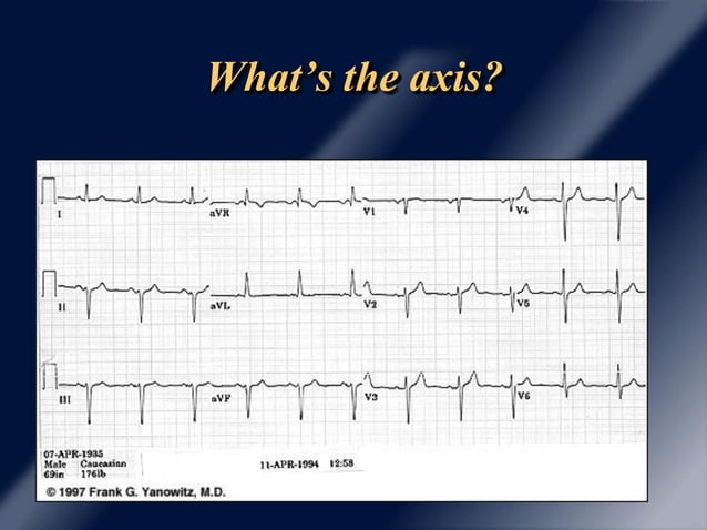 Pediatric EGC interpretation... Overview of pediatric ECG | PDF