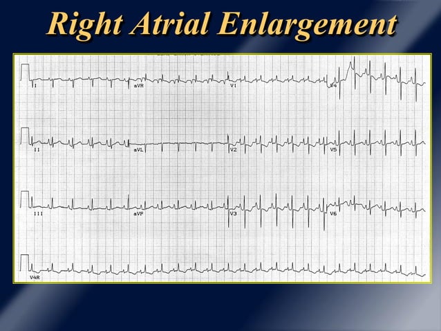 Pediatric EGC interpretation... Overview of pediatric ECG | PDF