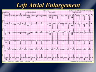 Pediatric EGC interpretation... Overview of pediatric ECG | PDF