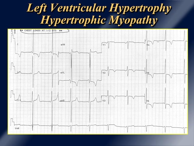 Pediatric EGC interpretation... Overview of pediatric ECG | PDF