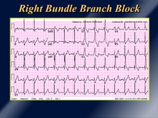 Pediatric EGC interpretation... Overview of pediatric ECG | PDF