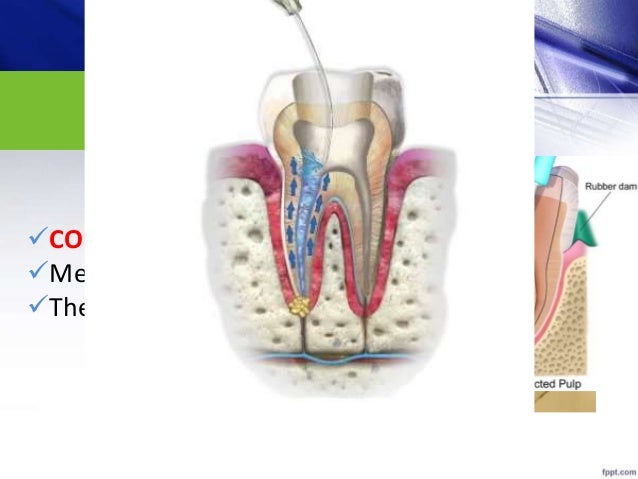 Current concept of endodontic irrigation