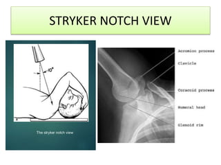 Current concepts in the management of shoulder instability | PPTX ...