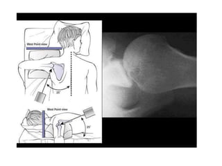 Current concepts in the management of shoulder instability | PPTX ...