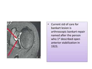 Current concepts in the management of shoulder instability | PPTX
