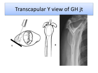 Current concepts in the management of shoulder instability | PPTX ...