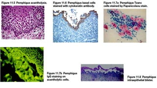 Current concepts of pemphigus with a deep insight into its molecular ...