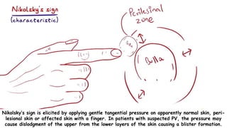 Current concepts of pemphigus with a deep insight into its molecular ...