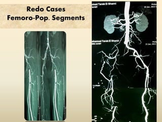 Current indications of endovascular management of infrai̇nguinal cli | PPTX