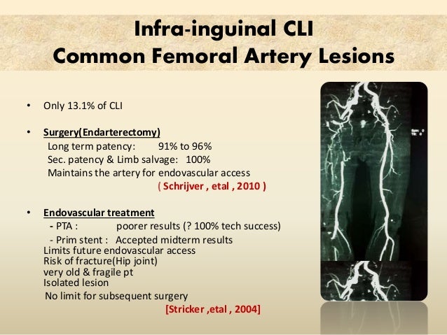 Current indications of endovascular management of infrai̇nguinal cli