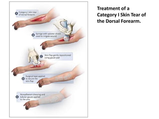 Current Management of Acute Cutaneous Wounds | PPTX