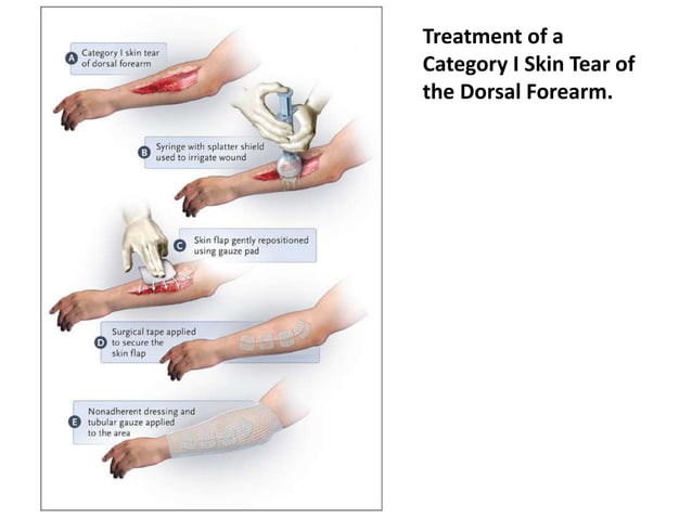Current Management of Acute Cutaneous Wounds | PPT