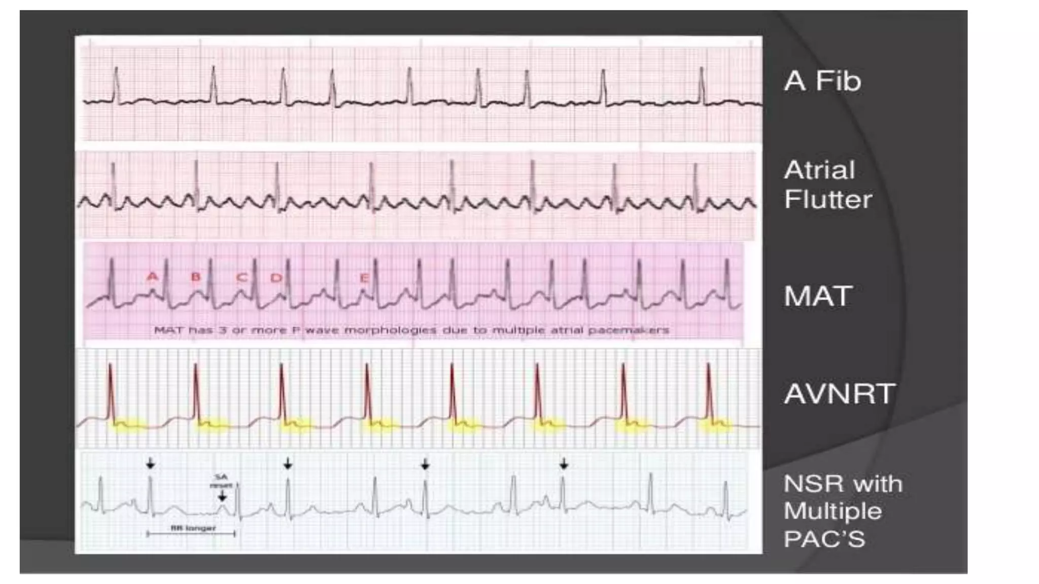 Current management of atrial fibrillation | PPTX