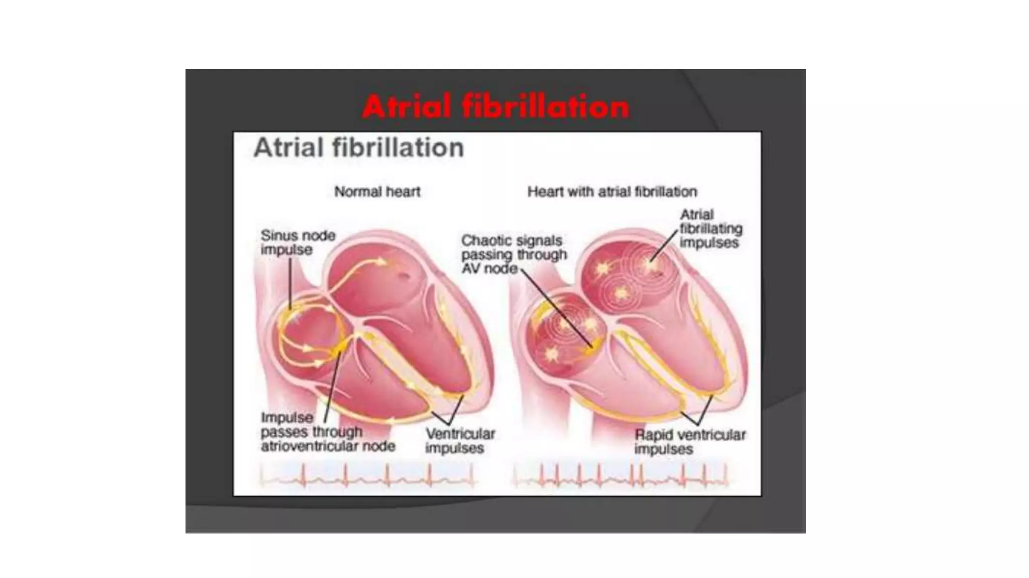 Current management of atrial fibrillation | PPTX