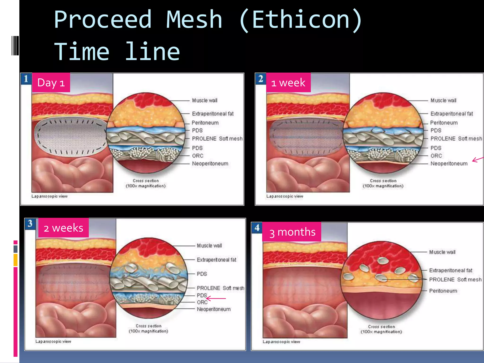 Current management of incisional hernia | PPTX