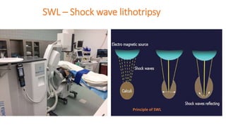 current management of renal calculi ( PCNL RIRS ESWL).pptx