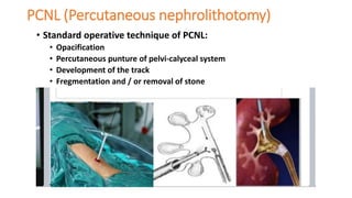 current management of renal calculi ( PCNL RIRS ESWL).pptx