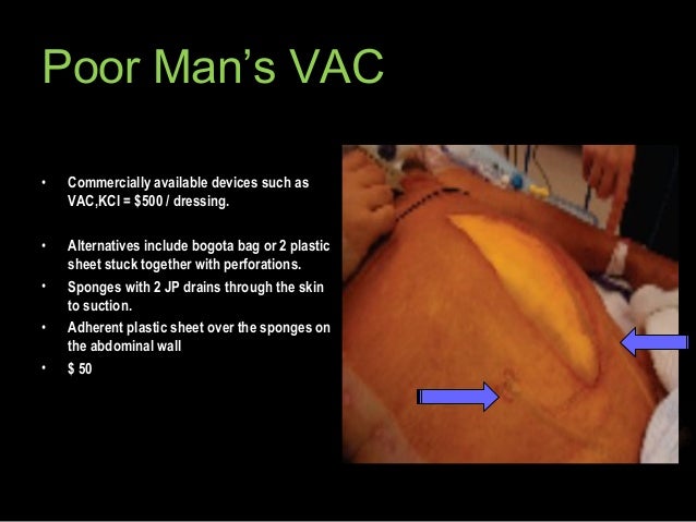 Delayed Primary Closure Of Extensive Wounds Using The Topclosure System