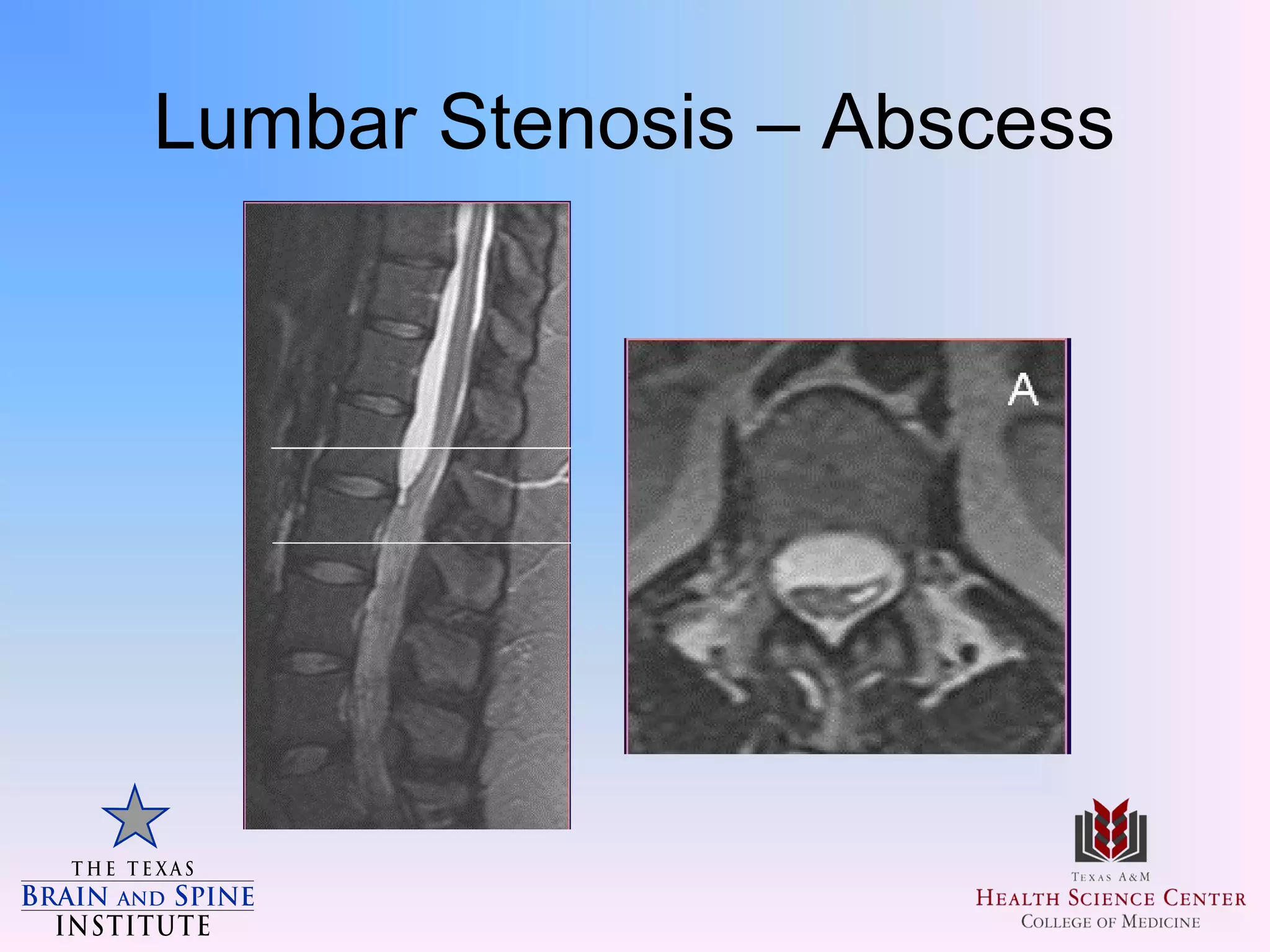 Current treatment of lumbar stenosis | PPT