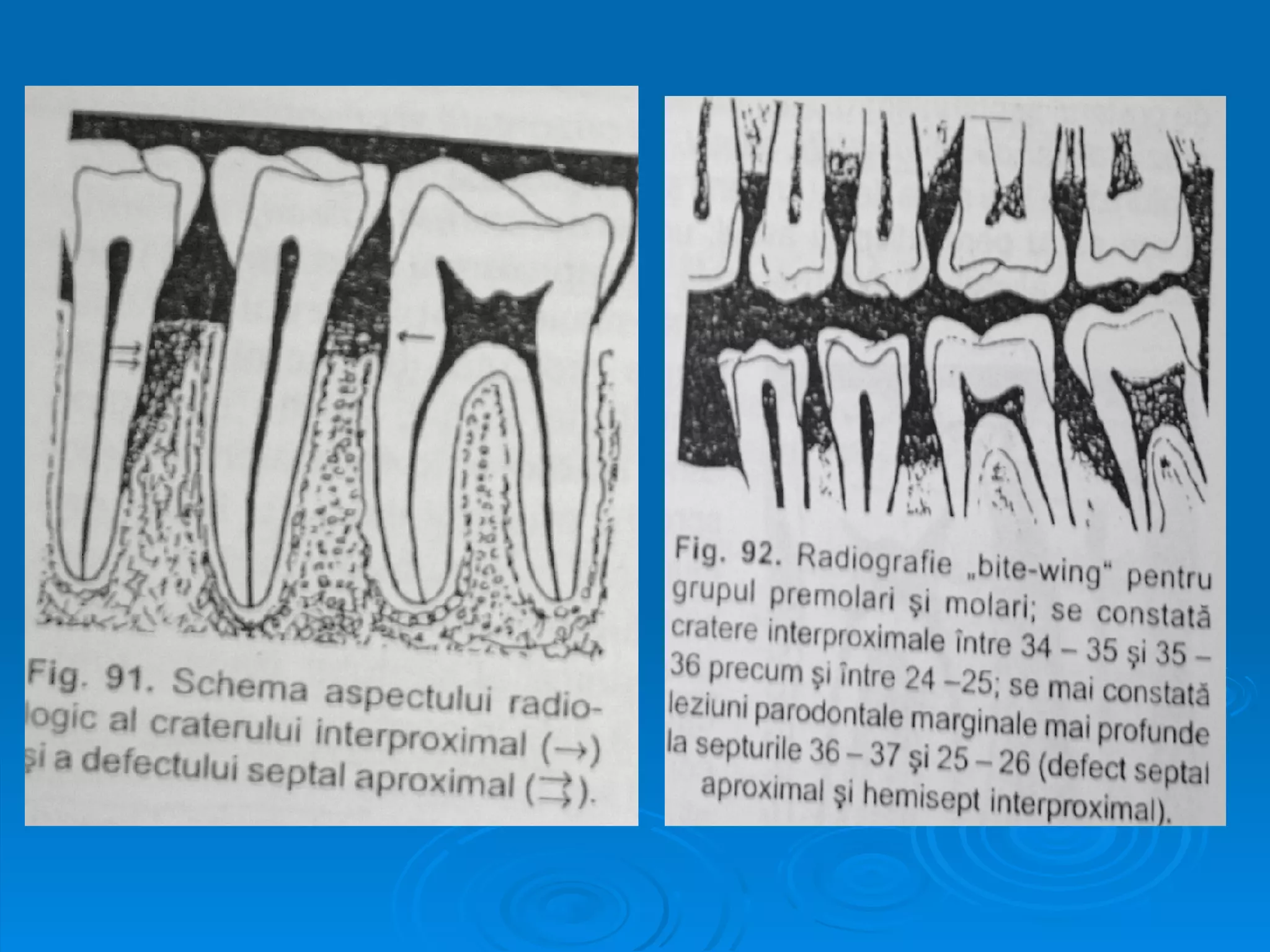 Curs 3 radiodiagnosticul parodontitelor apicale | PPT