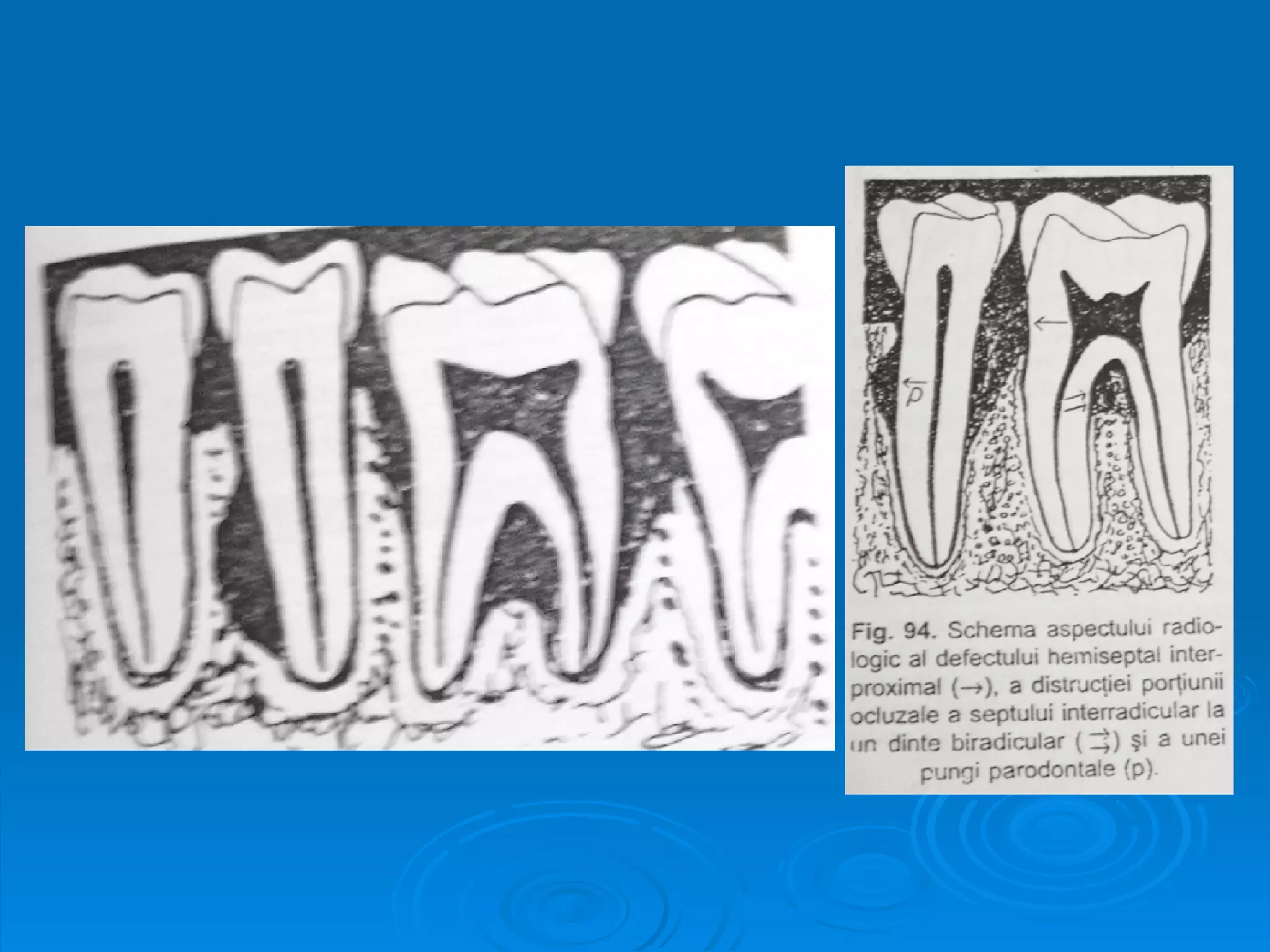 Curs 3 radiodiagnosticul parodontitelor apicale | PPT