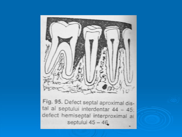 Curs 3 radiodiagnosticul parodontitelor apicale | PPT