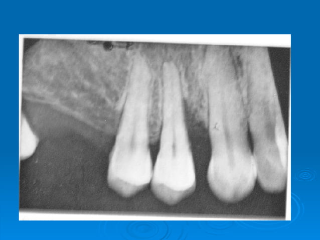 Curs 3 radiodiagnosticul parodontitelor apicale | PPT