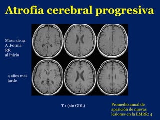Curso clinico esclerosis multiple | PPT