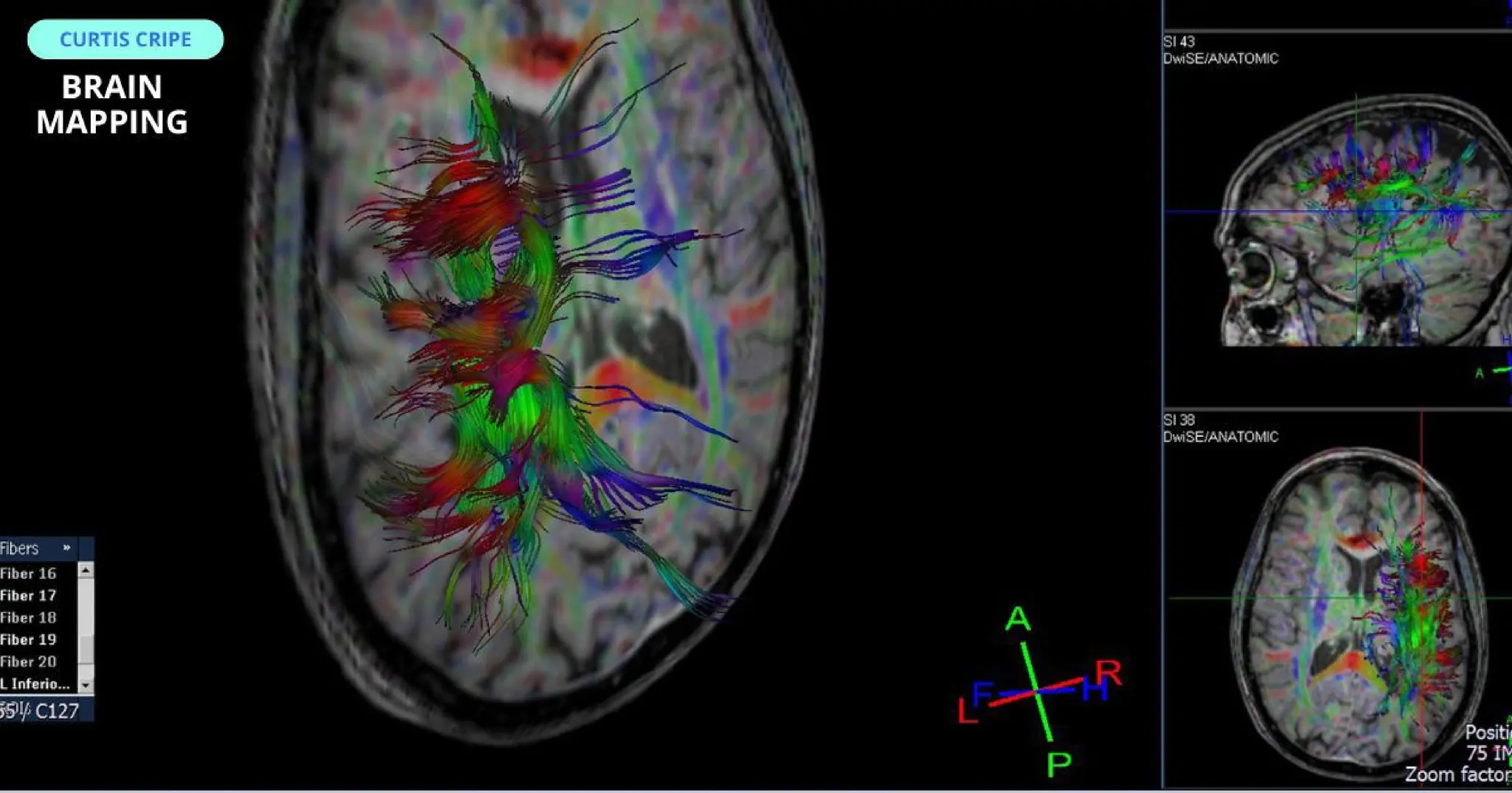 Brain Mapping Is The Process Of Using Imaging Techniques To Create