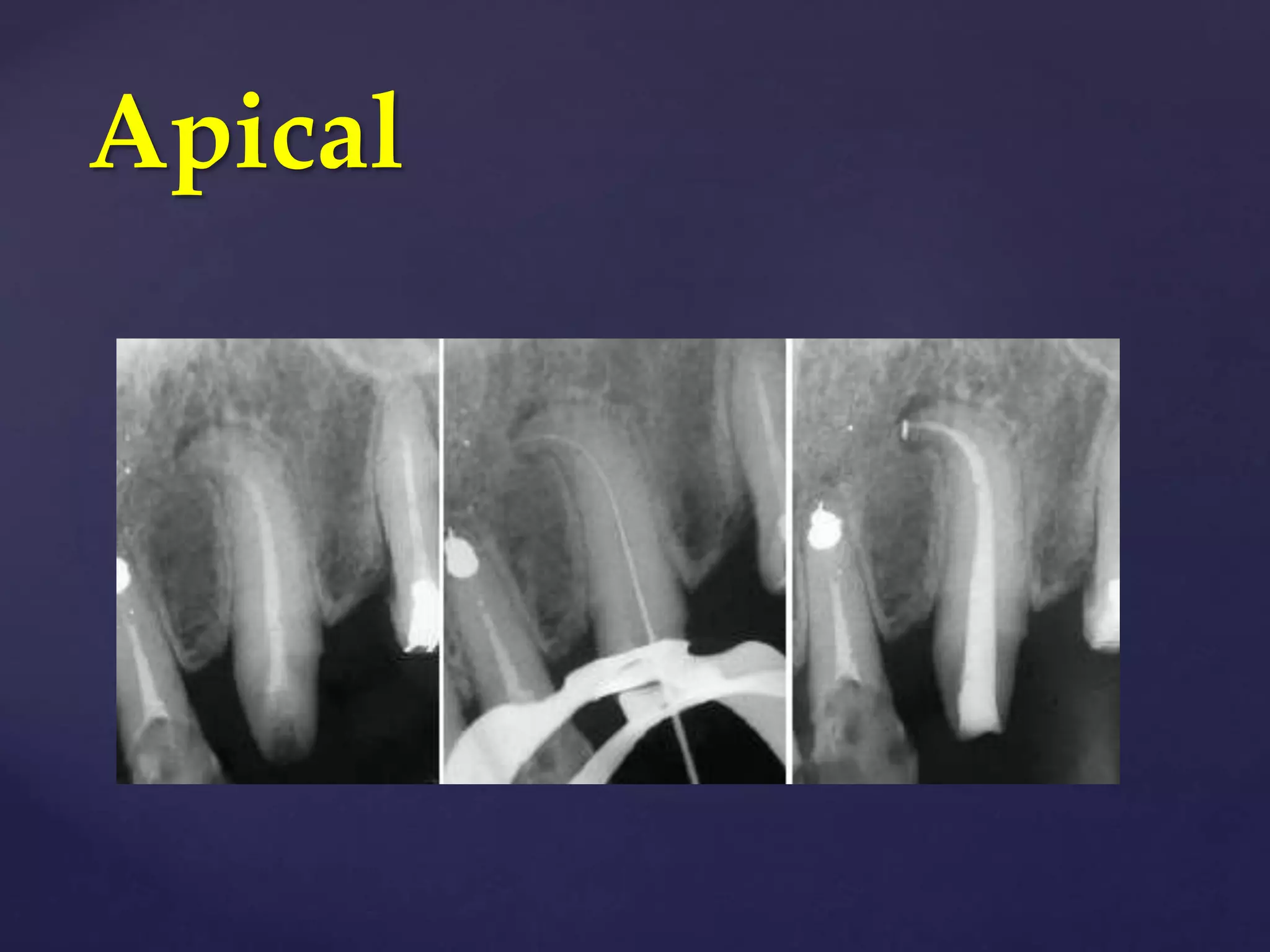 Curved & dilacerated canals | PPTX