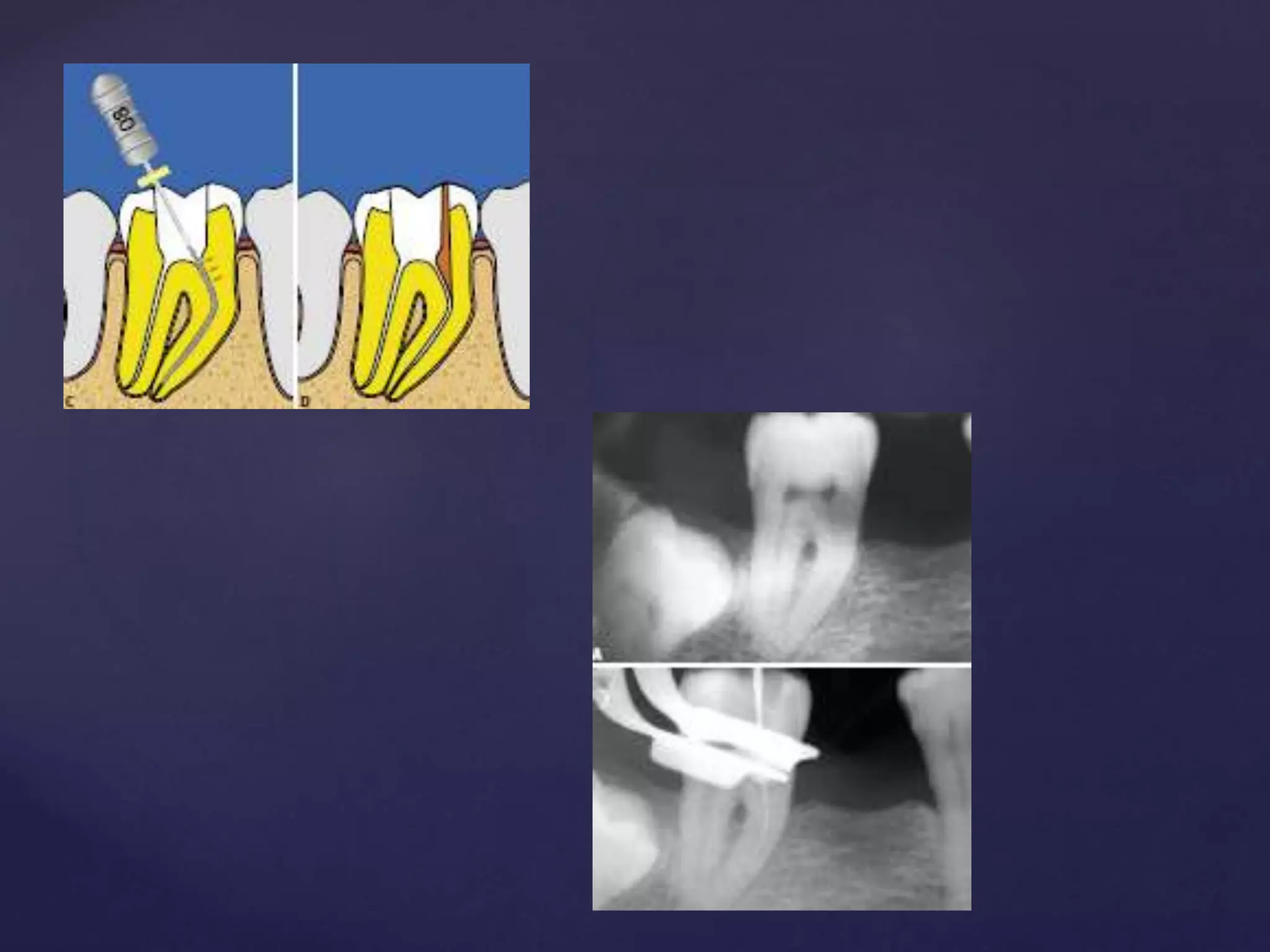 Curved & dilacerated canals | PPTX